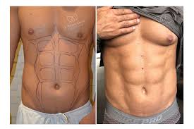Plastic surgeons help people get 'six-pack abs' - Jammu Kashmir Latest ...