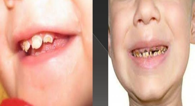 Baby bottle caries - Daily Excelsior