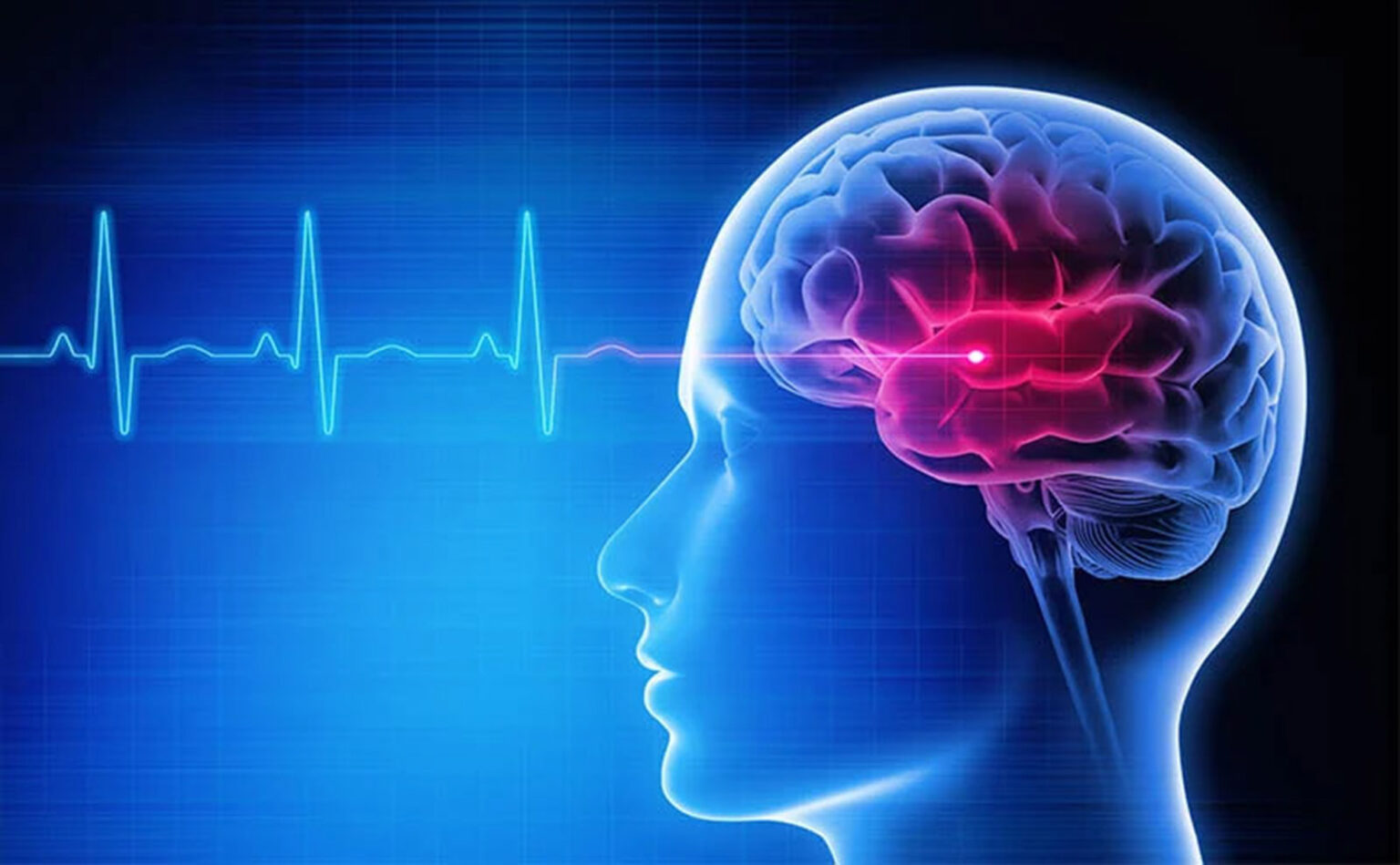 Young Stroke : Why It's not just an "Old Person's disease" - Daily ...